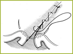 Hydrometra: A Predictor of Gynecological Cancers