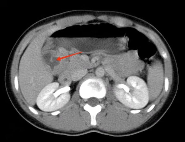Utrecht Suture Pattern: Techniques & Tips